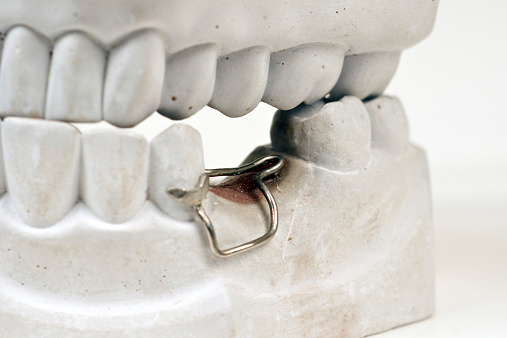 Orthodontic Space Maintenance | Tulsa Dentist | T-Town Smiles